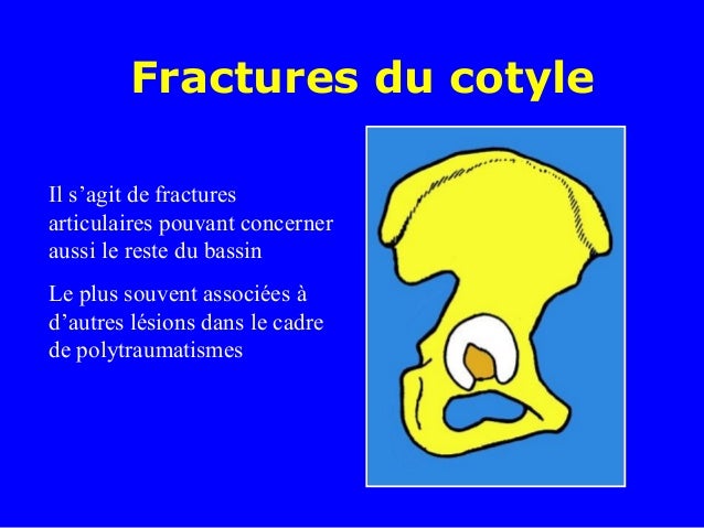 04 fractures du cotyle (1)