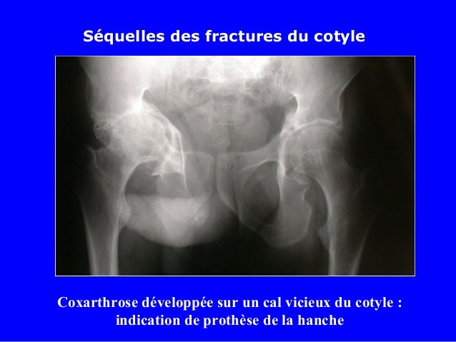 04 fractures du cotyle (1)