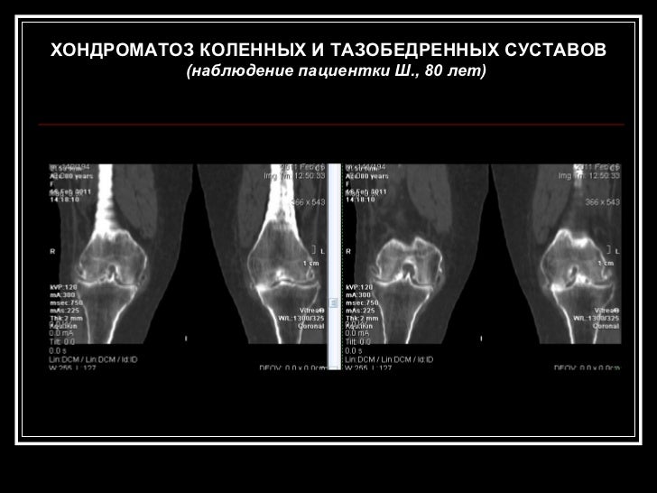 Хондроматоз коленного сустава фото