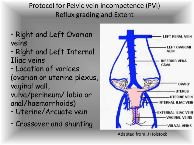 Insuficiencia Venosa Pélvica Dr Puras