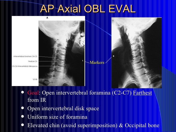 125 Week 11 Cervical Spine