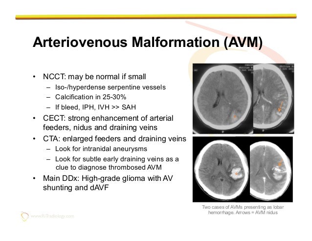 Imaging of Non-traumatic Intracranial Hemorrhage