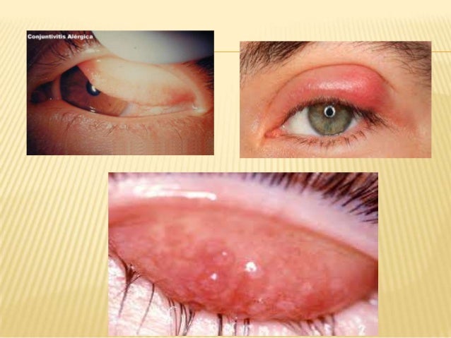 22 Infecciones Oculares 1