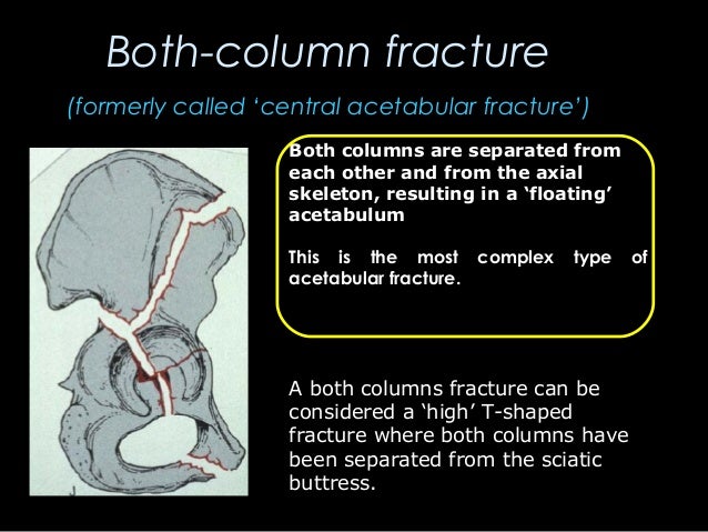 26 Acetabular Fractures Anatomy Evaluation And Classification