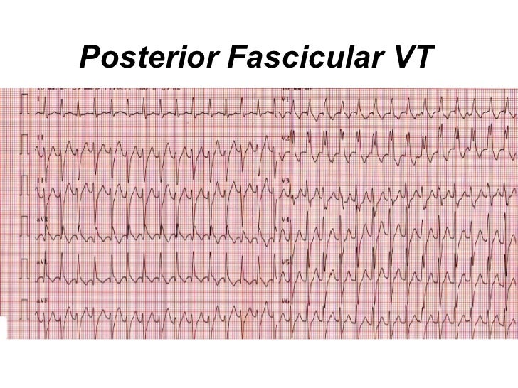 Catheter ablation of ventricular tachycardia