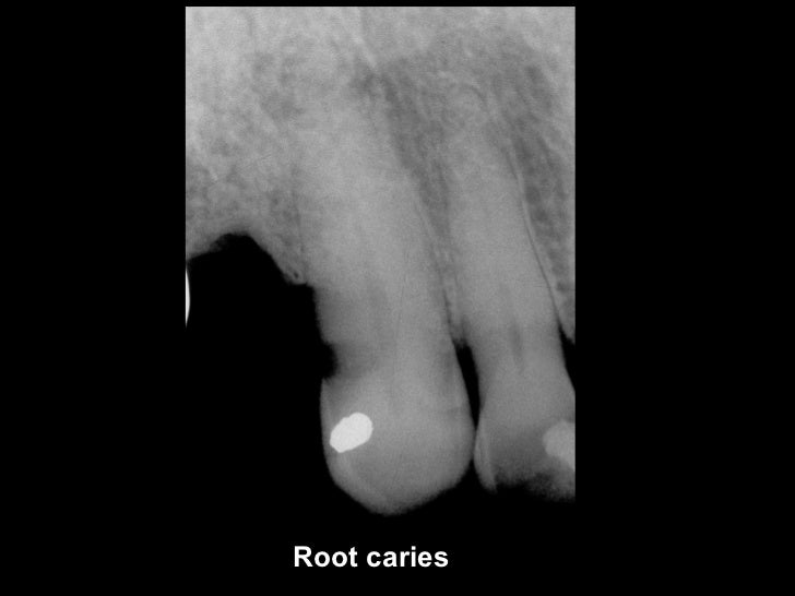 Radiographic Caries Diagnosis