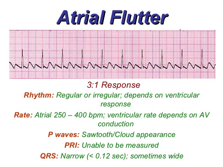 Difference between typical and atypical atrial flutter - shipmoli