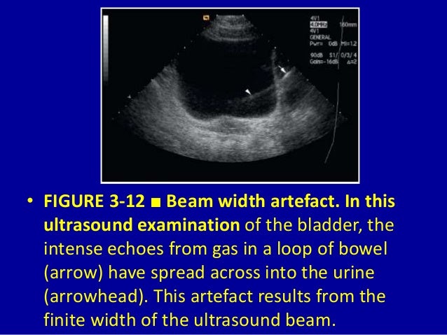 Beam Width Artifact beam-width-artifact