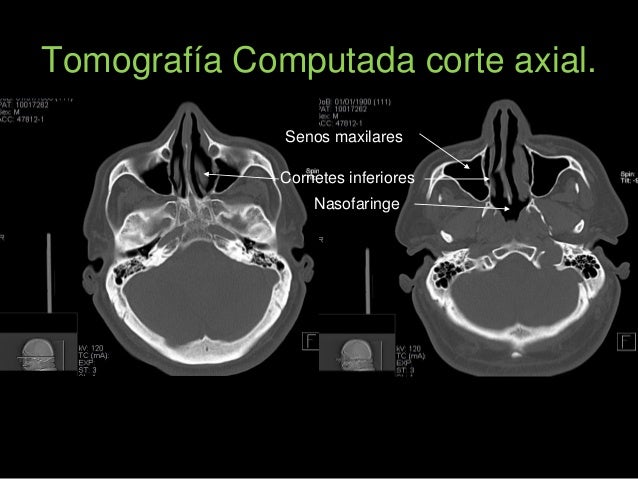 5.3 anatomía seccional de los senos paranasales por tchm