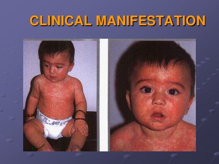 Branny Desquamation Measles - PPT - MEASLES PowerPoint Presentation ... Branny Desquamation Measles - PPT - MEASLES PowerPoint Presentation ...