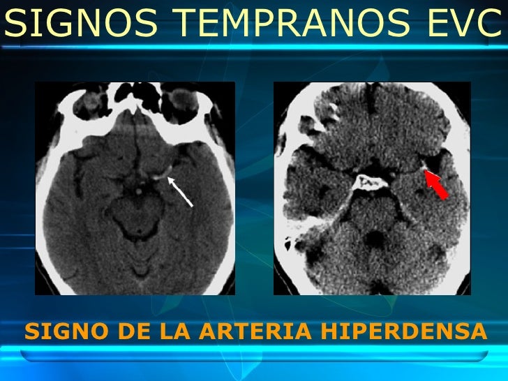 Enfermedad Vascular Cerebral