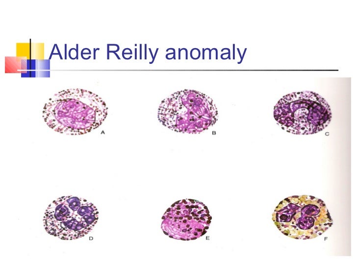 Abnormalities of WBC