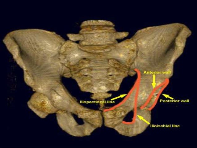 Acetabular Fracture