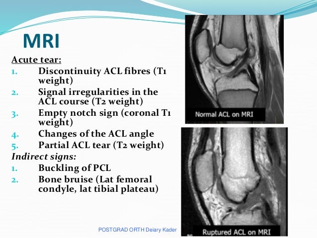 Updated Acl And Mcl Injuries For Postgraduate Orthopaedic Course In N