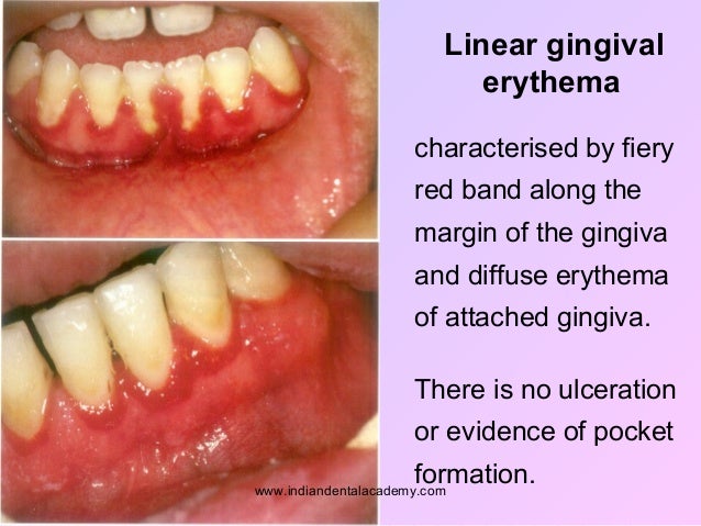 Linear Gingival Erythema Journal Of Syiah Kuala Dentistry Society