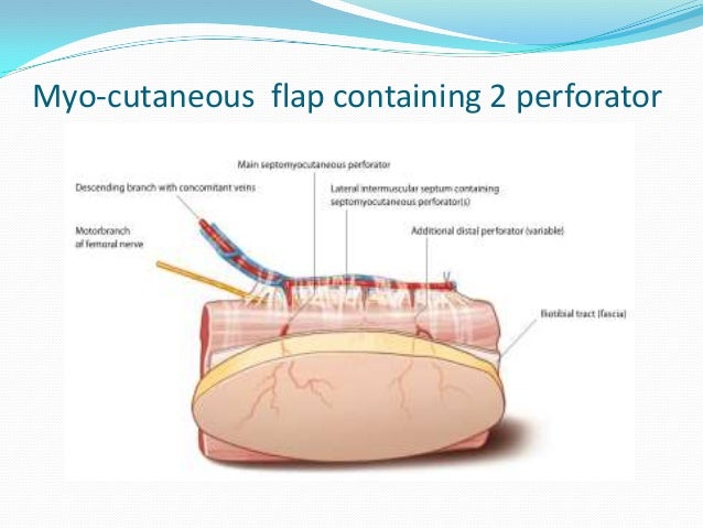 Anterolateral thigh flap