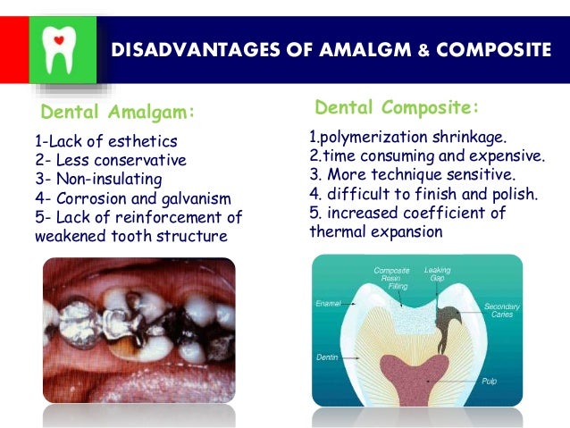 Amalgam &composite