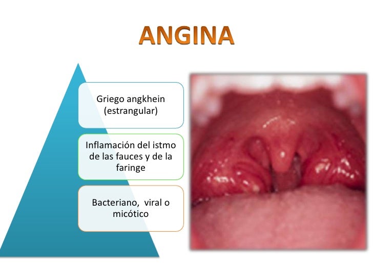 Anginas De Las Enfermedades Infectocontagiosas