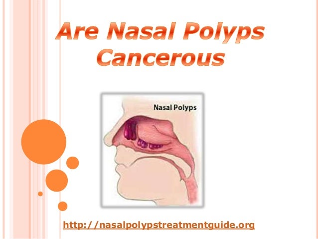 Are nasal polyps cancerous