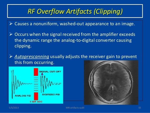 MRI artifacts
