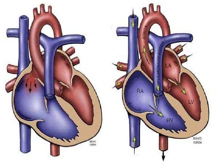 A Case Of Asd Sinus Venosus Type