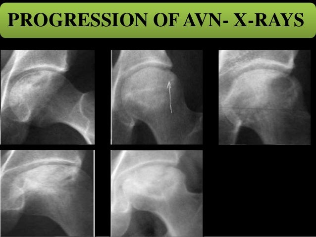 AVASCULAR NECROSIS OF HIP AVN HIP AVASCULAR NECROSIS OF HIP AVN HIP
