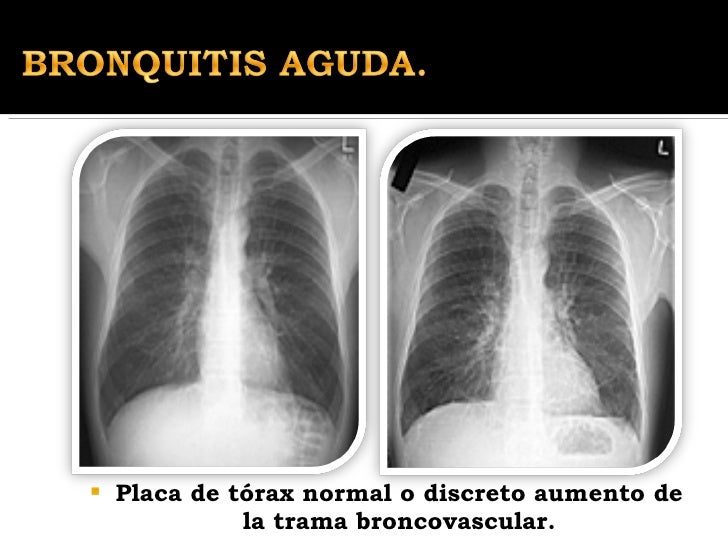 Bronquitis Aguda