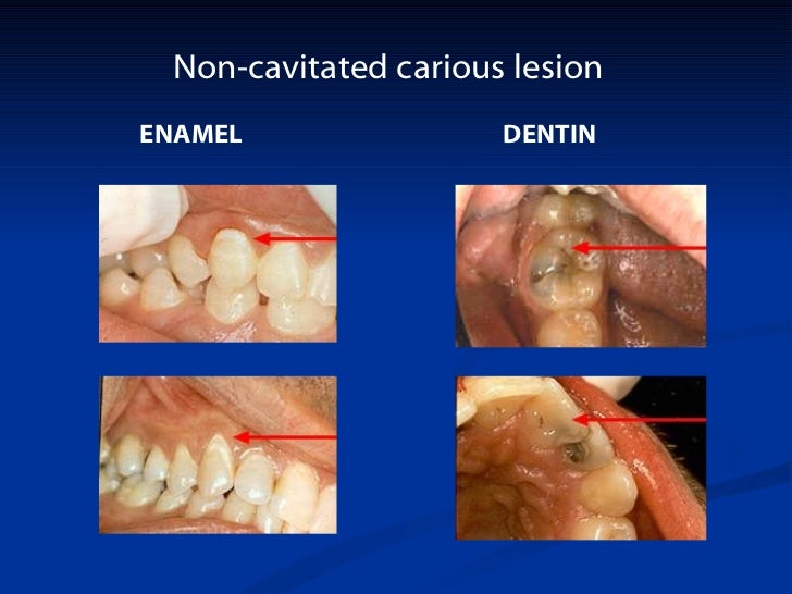 Caries Diagnosis