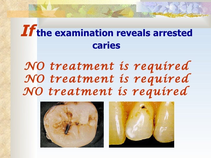 Caries Treatment