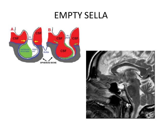 Empty Sella Syndrome Empty Sella Syndrome Primary Empty