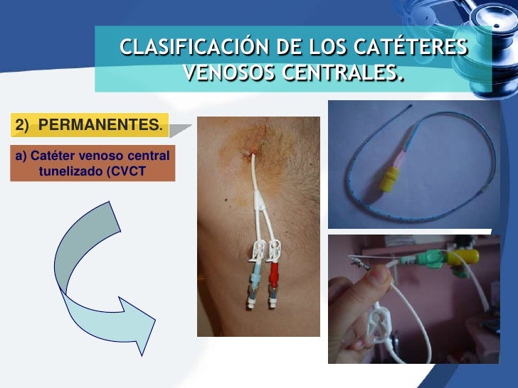 Catéter venoso central