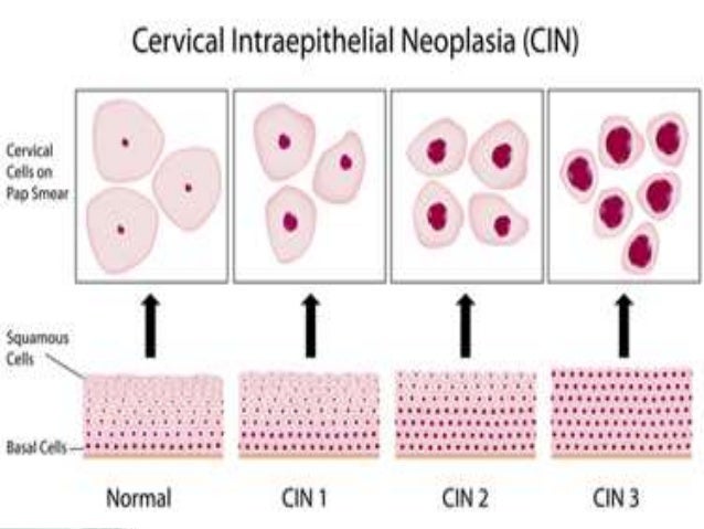Cervical Intraepithelial Neoplasia