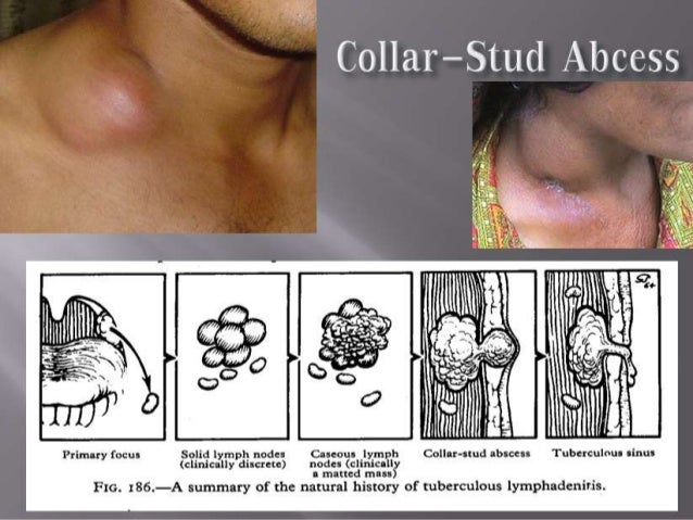 Cervical Lymphadenopathy
