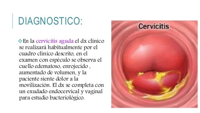 Cervicitis aguda y crónica, ectropion cervical, ulceracion, erosion.