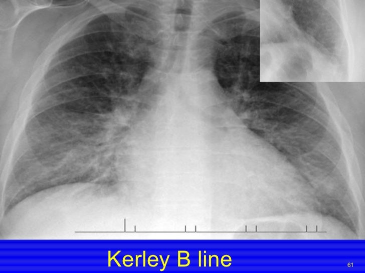 Chest Xray