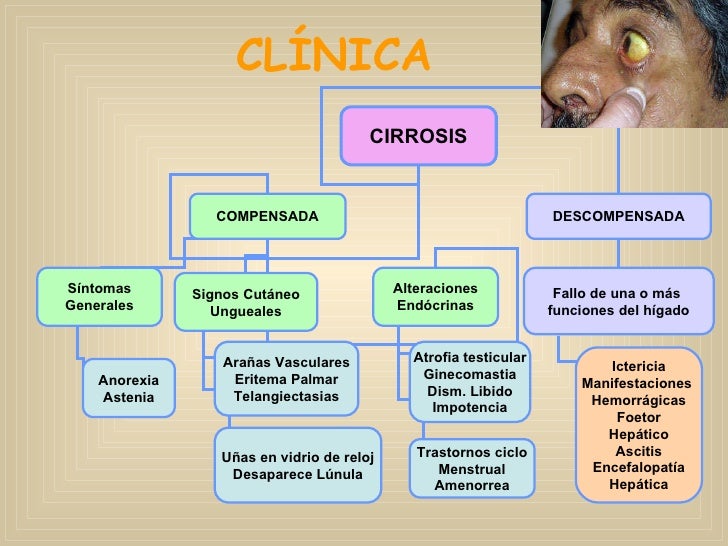 Cirrosis hepatica y complicaciones