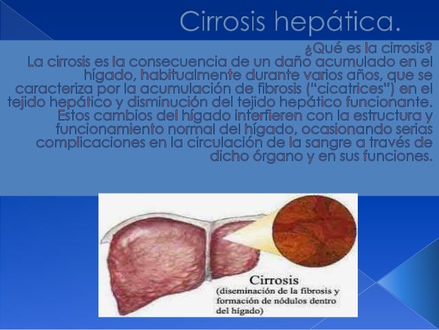 Cirrosis Hepática Causas Y Consecuencias