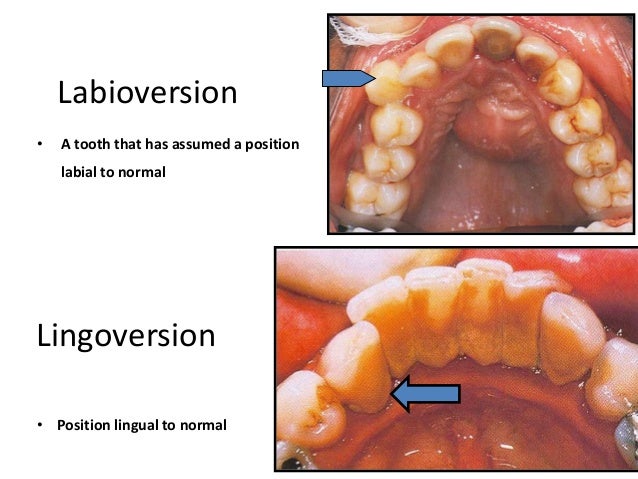 Classification of Occlusion and Malocclusion Dr. Nabil Al-Zubair