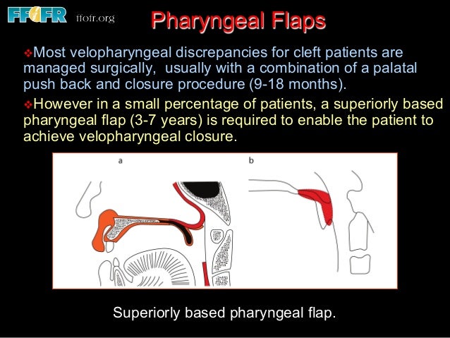 Cleft lip and palate