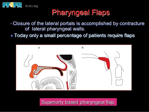 Cleft lip and palate