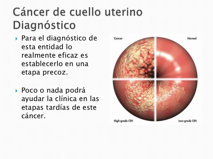 Cáncer de cuello uterino
