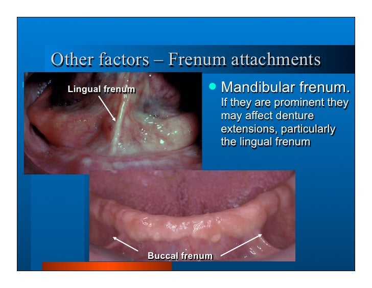 Mandibular Frenum Pull at Petra Hendrickson blog