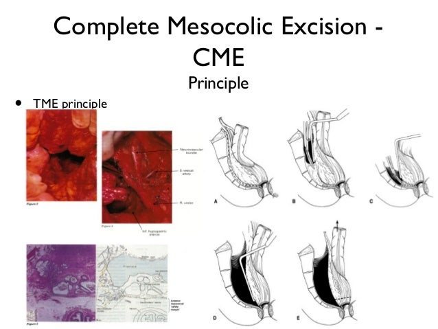 Complete mesocolic excision