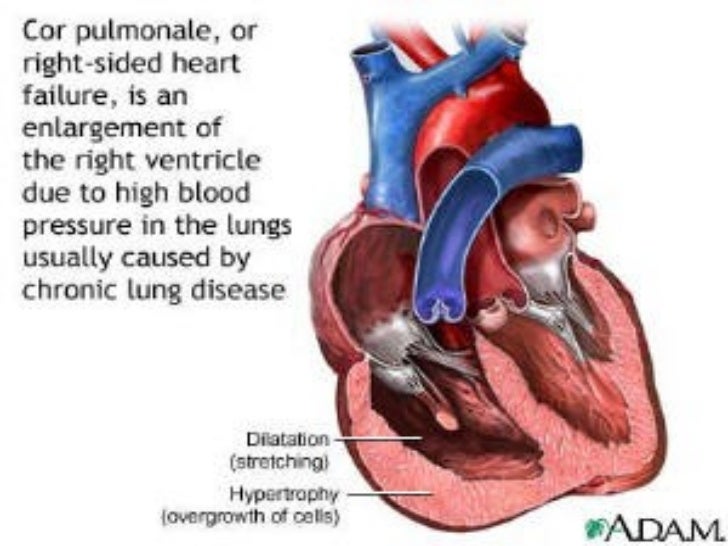 Cor Pulmonale Med koM cor-pulmonale-med-kom