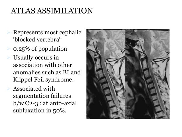 Craniovertebral juction 1 by dr mohammad mushtaq