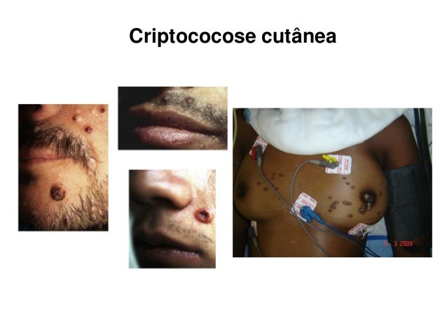Criptococose e Histoplasmose
