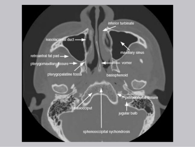Sphenoid Sinus Ostium Ct Marhtyuettahtyuisalas