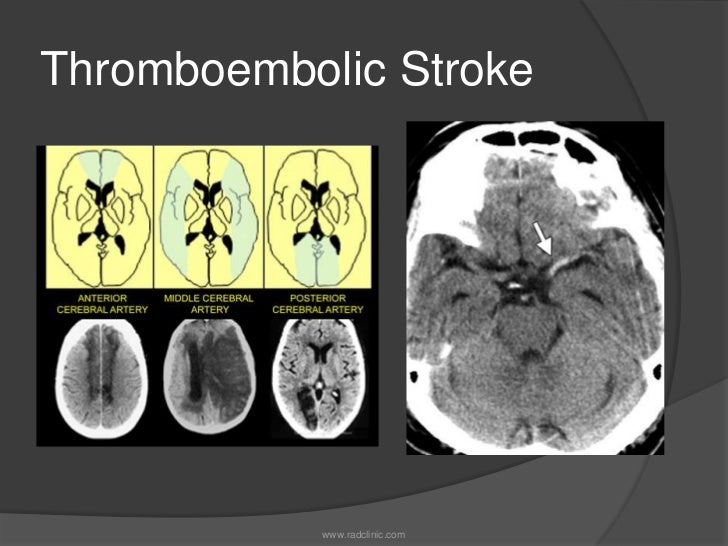 C T Imaging Of Acute Stroke