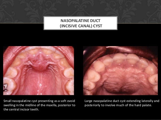 Cyst Of Jaw