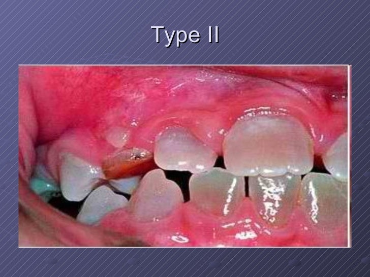 Dentinogenesis imperfecta
